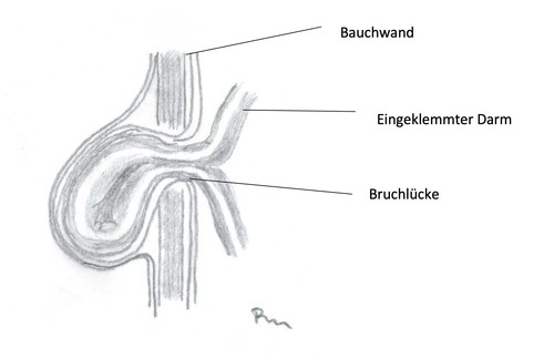 Hernienchirurgie | Chirurgie am Stadtgarten | Ettlingen