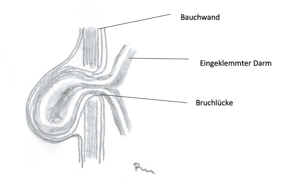 Hernienchirurgie | Chirurgie am Stadtgarten | Ettlingen
